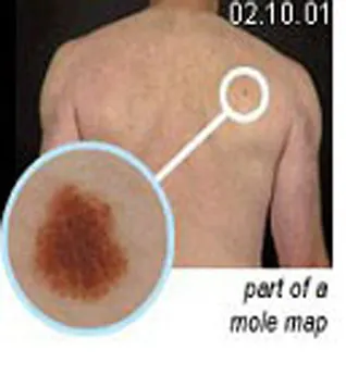 Welcome to The Skin Mole Clinic - Mole Clinic Joondalup, mole check ...