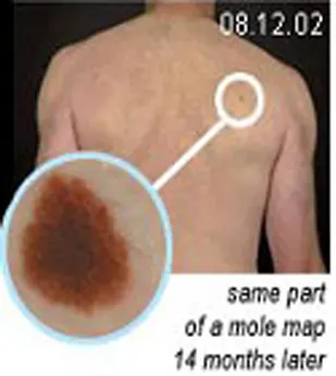 Welcome to The Skin Mole Clinic - Mole Clinic Joondalup, mole check ...